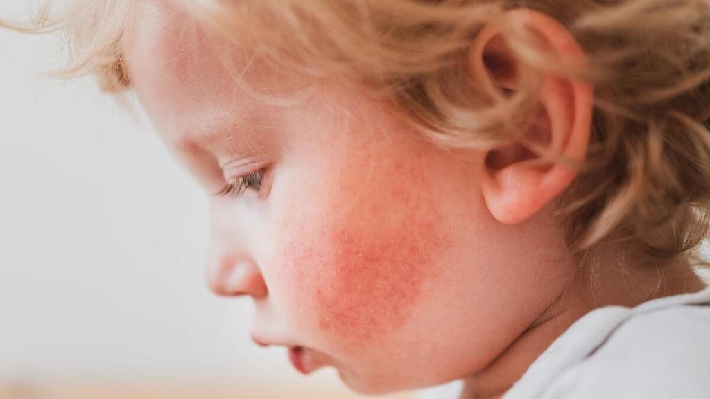Baby Red Cheeks What To Know Peanut Baby Red Cheeks What To Know Peanut