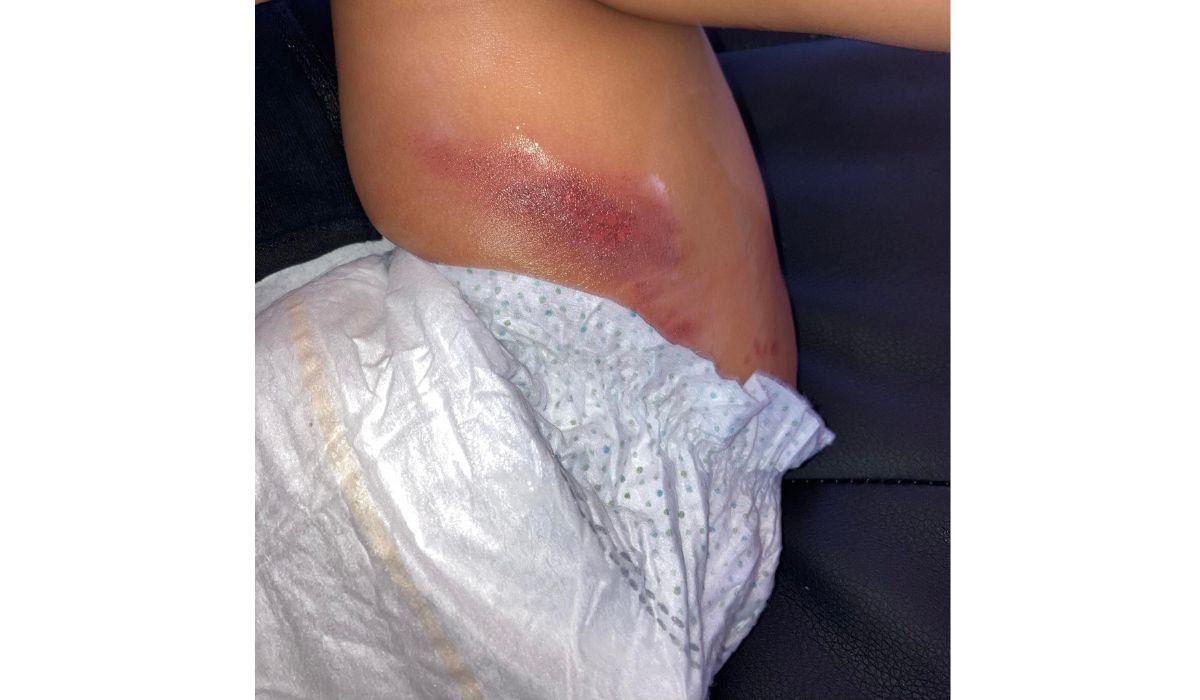 Baby Rash or Eczema? The Ultimate Guide to Baby Rashes | Peanut